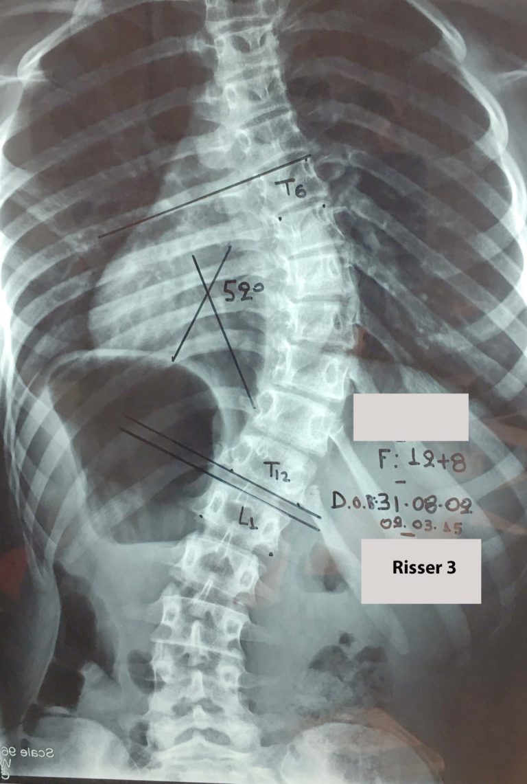 ΑΠΟΚΑΤΑΣΤΑΣΗ ΤΗΣ ΟΣΤΙΚΗΣ ΣΥΝΕΧΕΙΑΣ ΤΩΝ ΠΛΕΥΡΩΝ ΜΕΤΑ ΑΠΟ ΠΛΕΥΡΟΠΛΑΣΤΙΚΗ ...