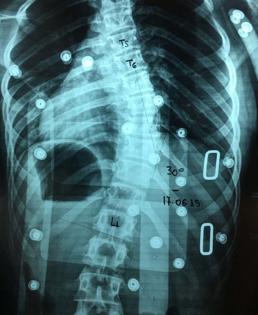 ΑΠΟΚΑΤΑΣΤΑΣΗ ΤΗΣ ΟΣΤΙΚΗΣ ΣΥΝΕΧΕΙΑΣ ΤΩΝ ΠΛΕΥΡΩΝ ΜΕΤΑ ΑΠΟ ΠΛΕΥΡΟΠΛΑΣΤΙΚΗ ...