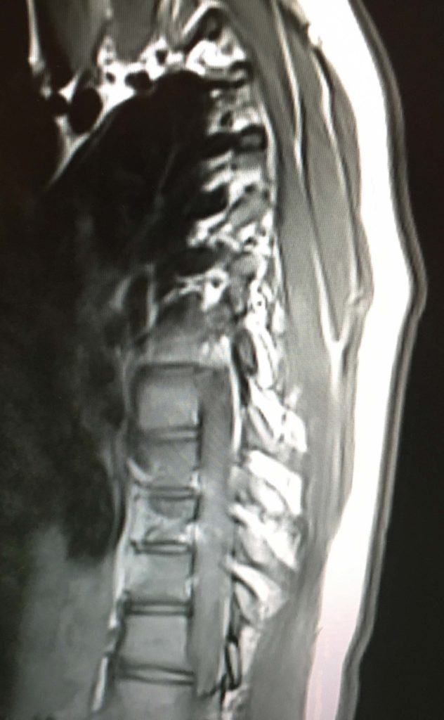 ΑΠΟΚΑΤΑΣΤΑΣΗ ΤΗΣ ΟΣΤΙΚΗΣ ΣΥΝΕΧΕΙΑΣ ΤΩΝ ΠΛΕΥΡΩΝ ΜΕΤΑ ΑΠΟ ΠΛΕΥΡΟΠΛΑΣΤΙΚΗ ...