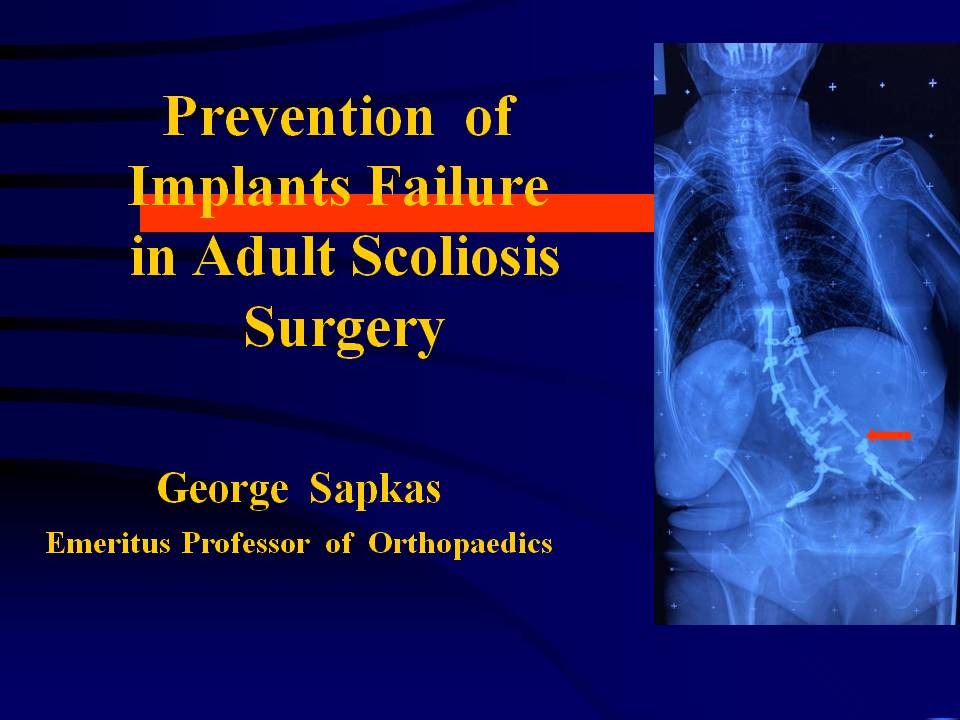 PREVENTION OF IMPLANTS FAILURE IN SPINE SURGERY - Professor G. Sapkas ...